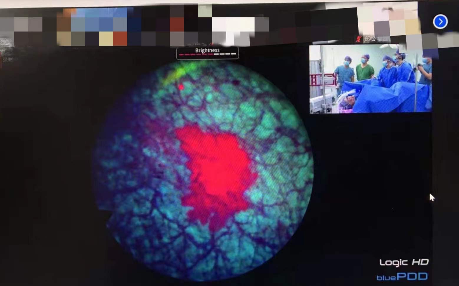 Bladder cancer diagnosis drug Hexvix® completed first patient procedure ...